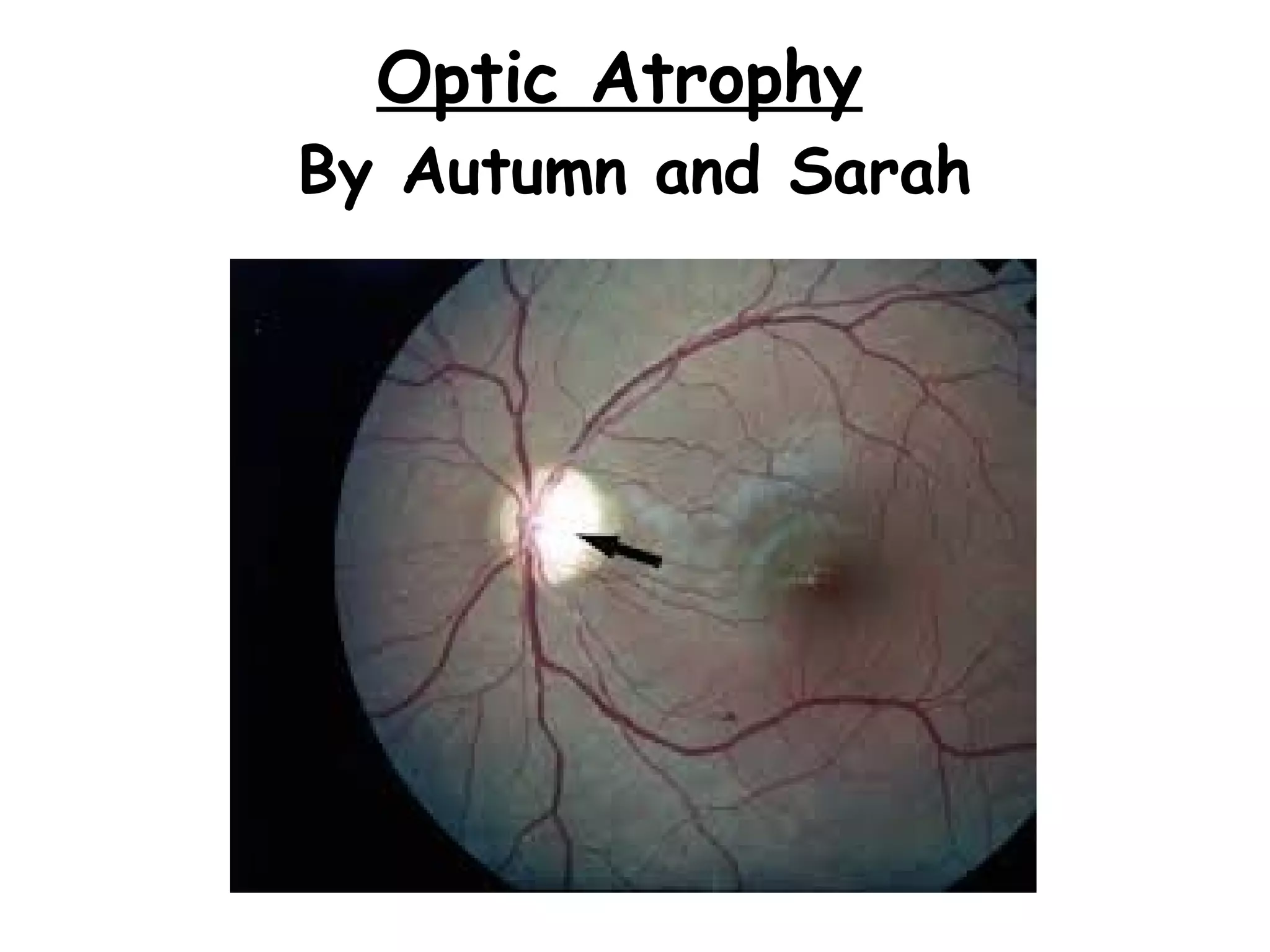 Optic atrophy sa | ODP