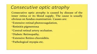 Optic atrophy | PPTX
