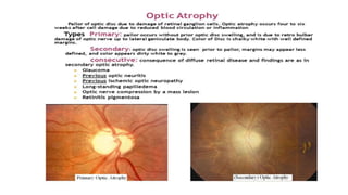 Optic atrophy | PPTX