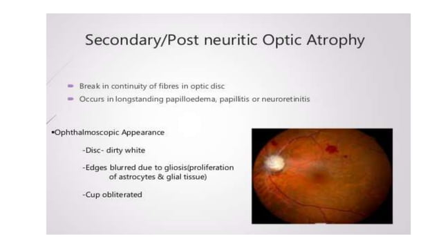 Optic atrophy | PPTX