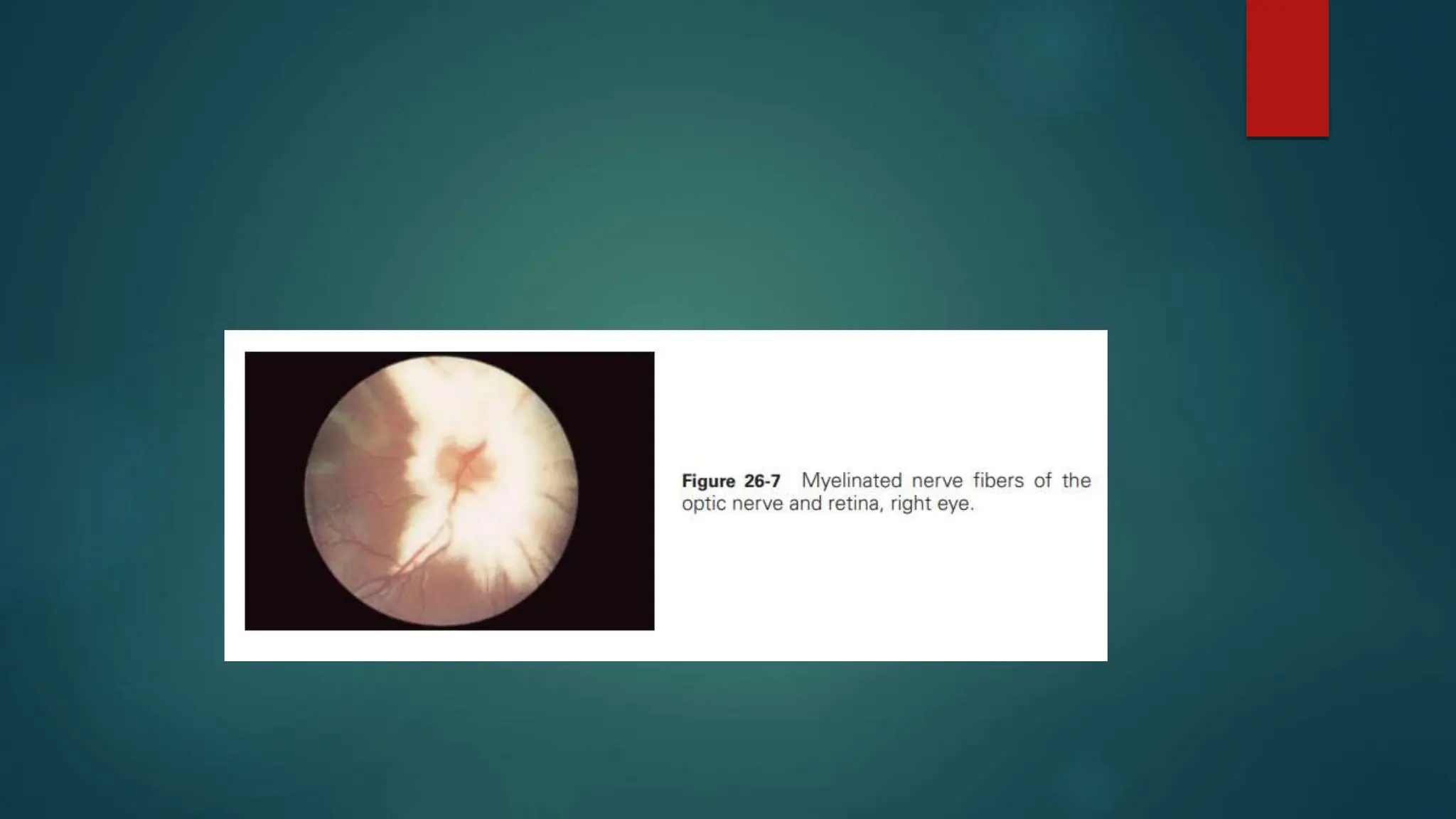 Optic Disc Abnormalities and their presentations | PPTX