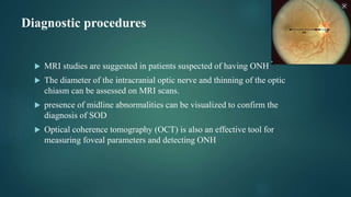 Optic Disc Abnormalities and their presentations | PPTX