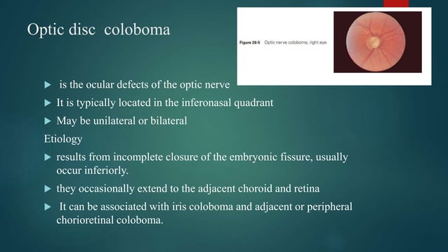 Optic Disc Abnormalities and their presentations | PPTX | Pregnancy ...