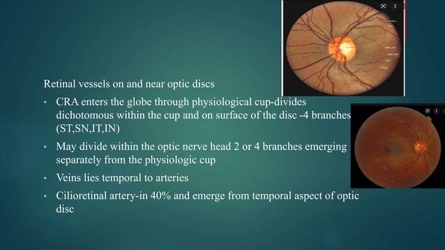 Optic Disc Abnormalities and their presentations | PPTX | Pregnancy ...