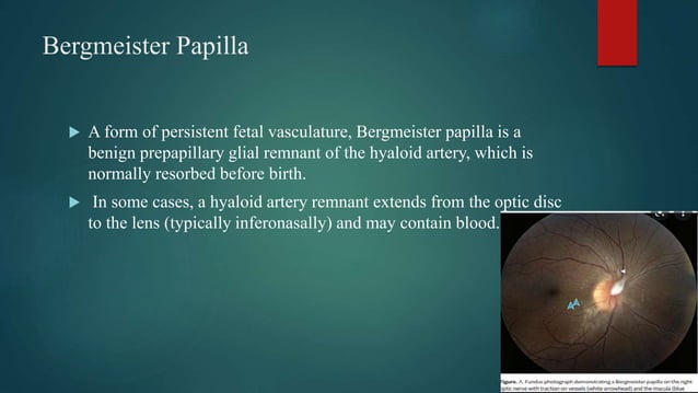 role of chemotherapy in retinoblastoma and other tumors | PPT