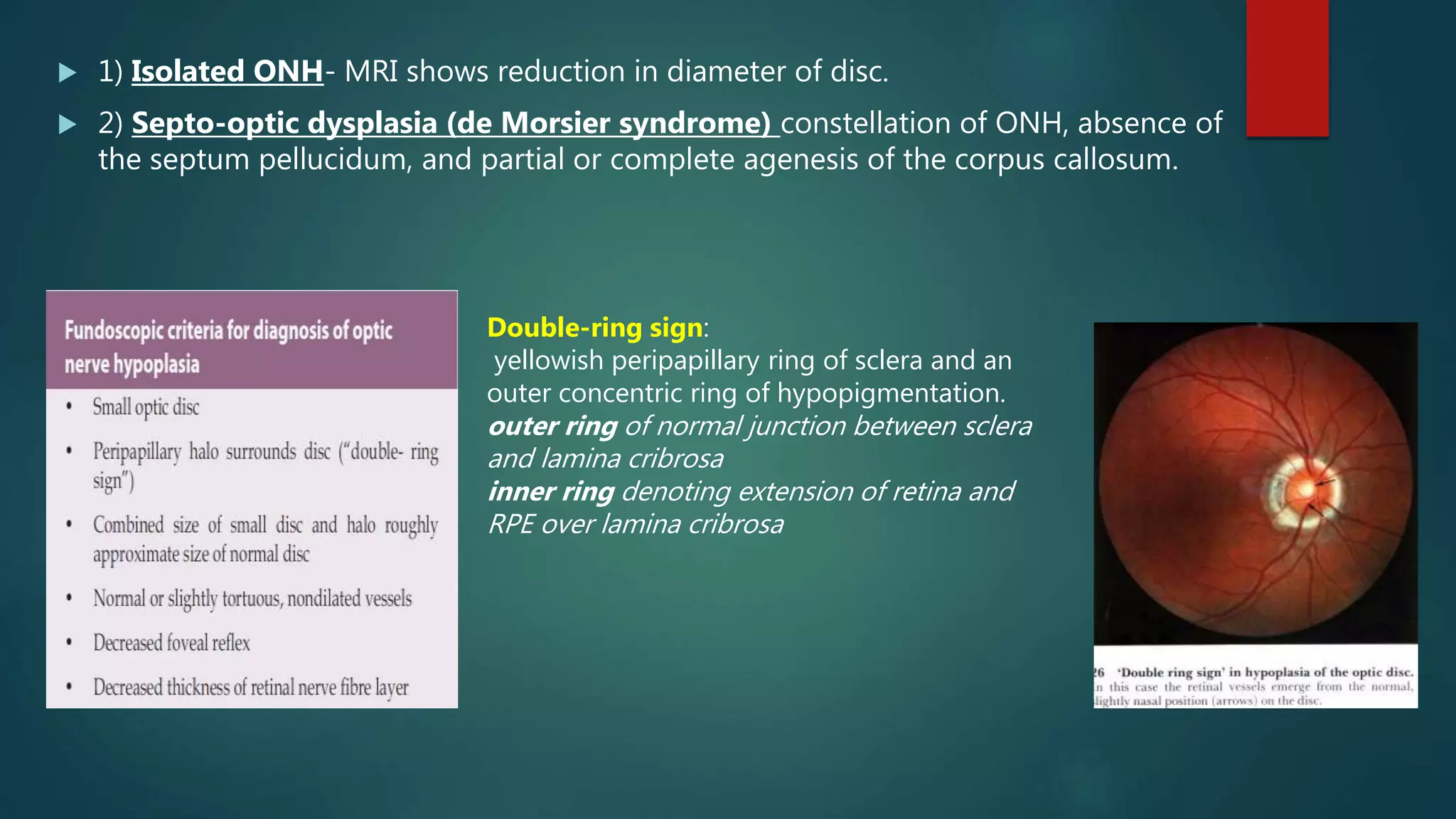 CONGENITAL OPTIC DISC ANOMALIES | PPTX