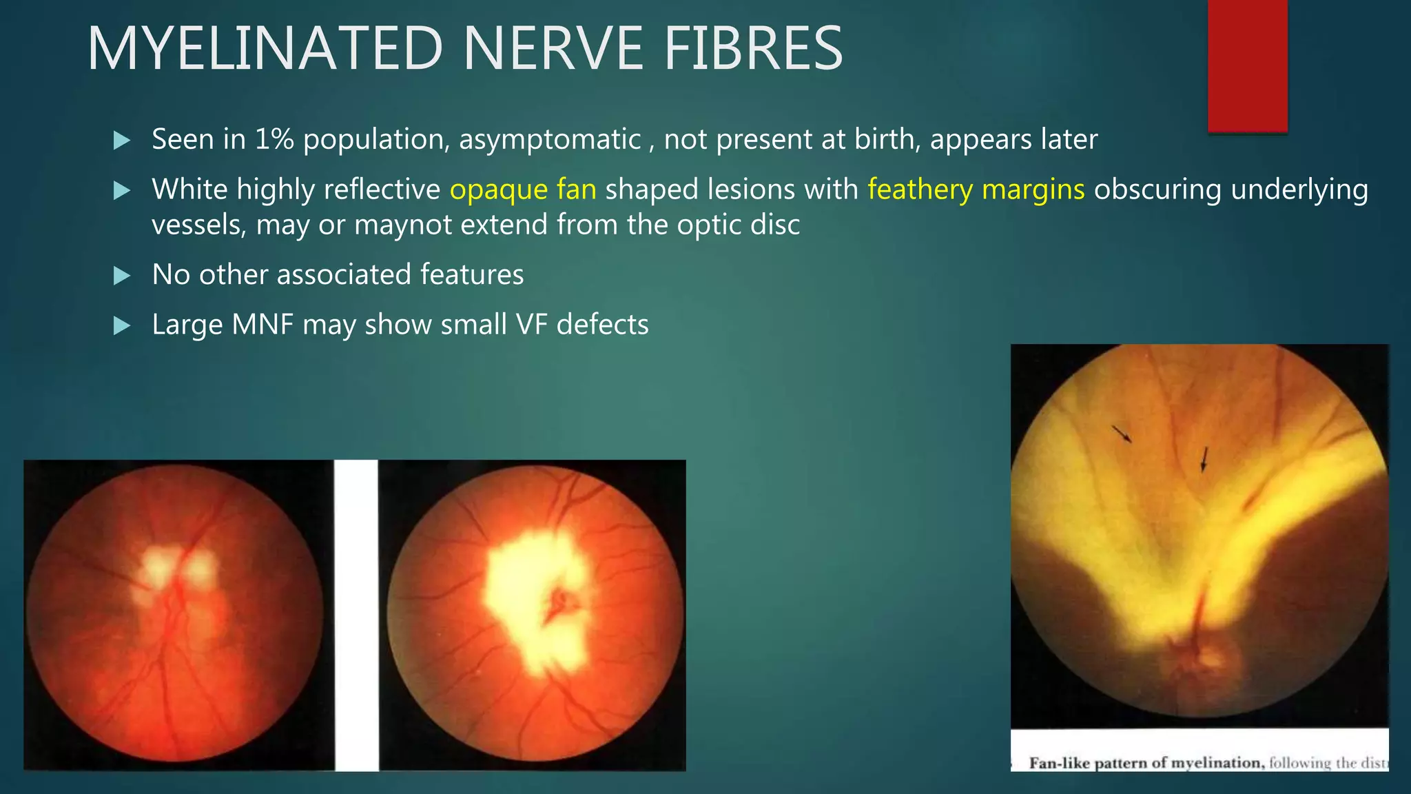 CONGENITAL OPTIC DISC ANOMALIES | PPTX