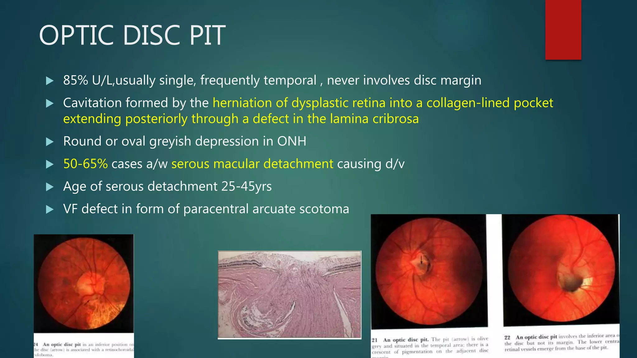 CONGENITAL OPTIC DISC ANOMALIES | PPTX