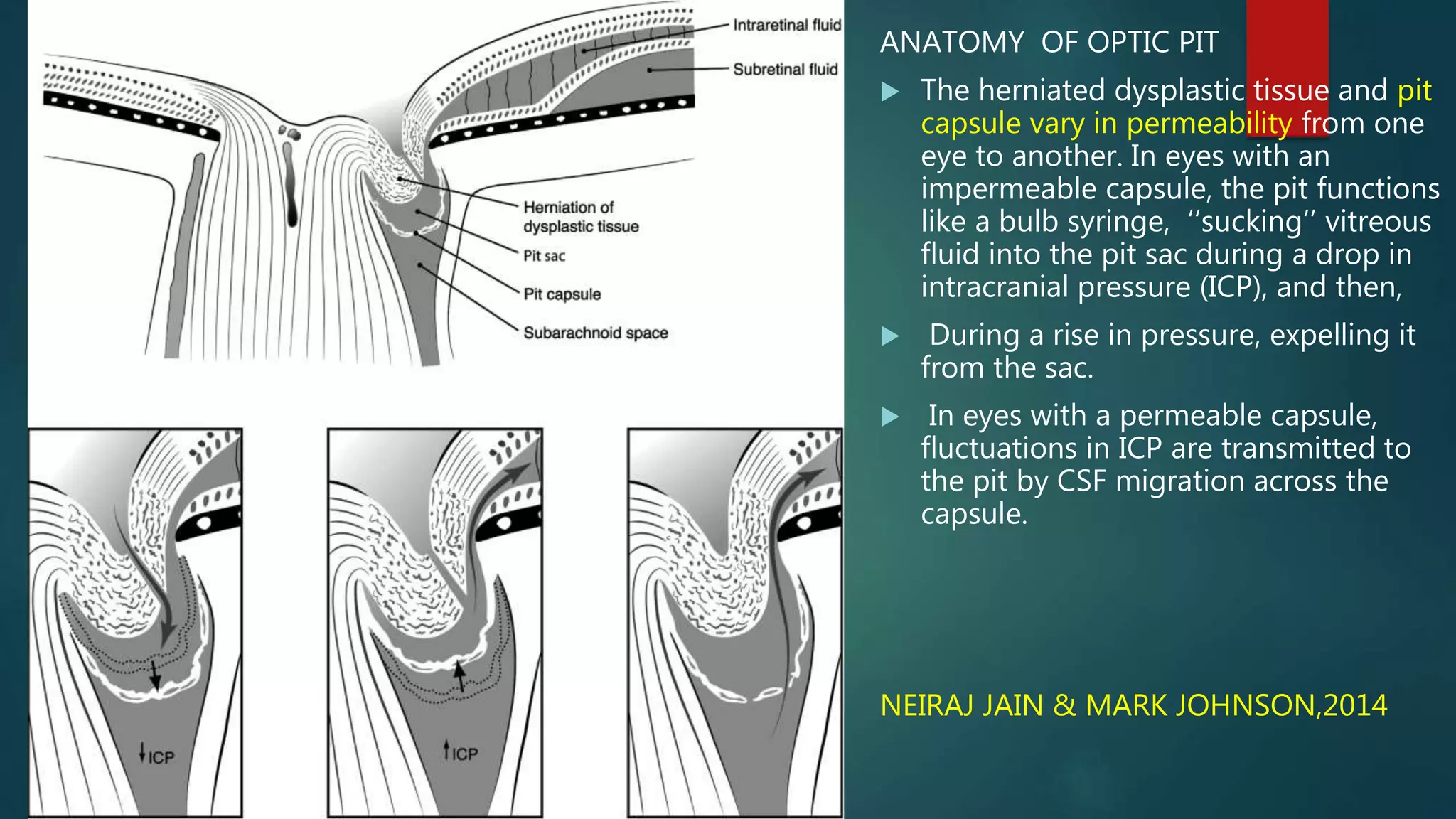CONGENITAL OPTIC DISC ANOMALIES | PPTX