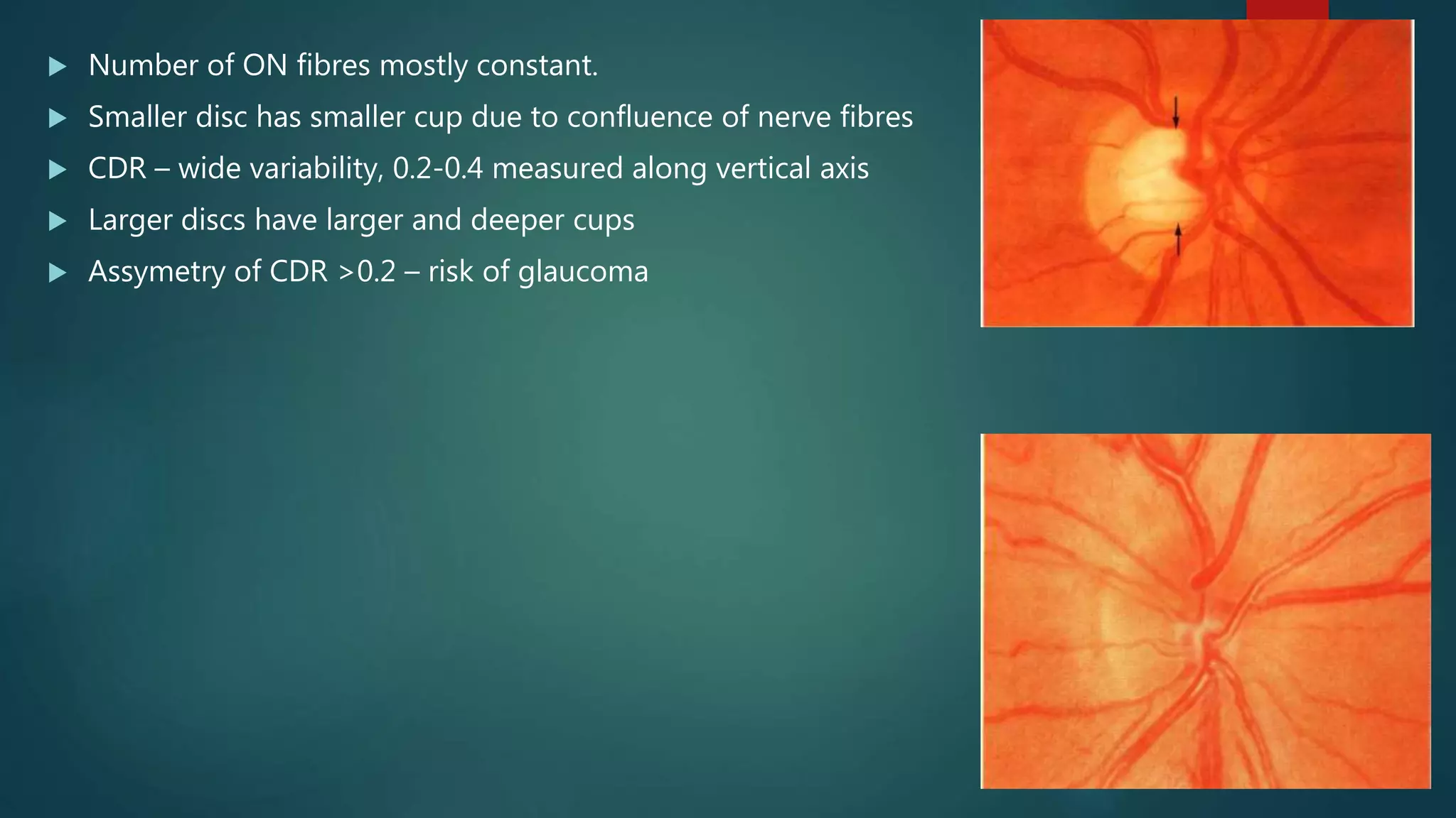 CONGENITAL OPTIC DISC ANOMALIES | PPTX