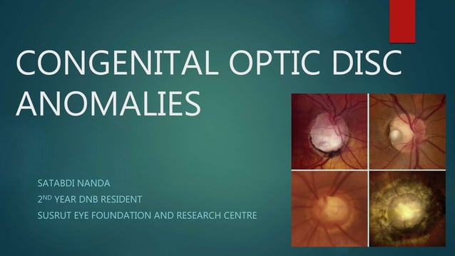 CONGENITAL OPTIC DISC ANOMALIES | PPTX | Eye and Vision Conditions ...