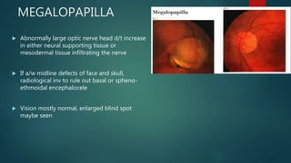 CONGENITAL OPTIC DISC ANOMALIES | PPTX
