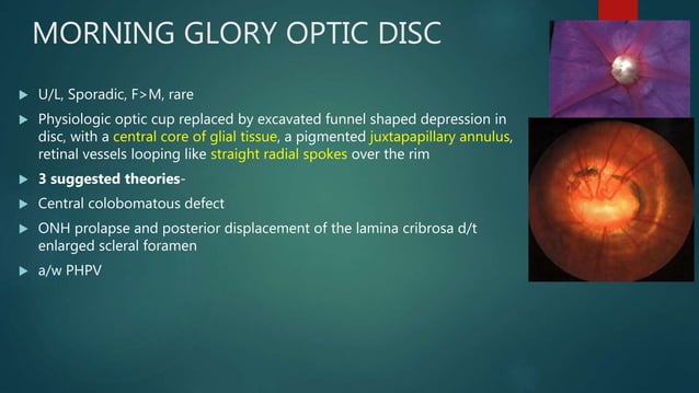 CONGENITAL OPTIC DISC ANOMALIES | PPTX | Eye and Vision Conditions ...