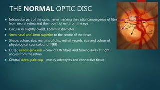 CONGENITAL OPTIC DISC ANOMALIES | PPTX