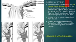 CONGENITAL OPTIC DISC ANOMALIES | PPTX