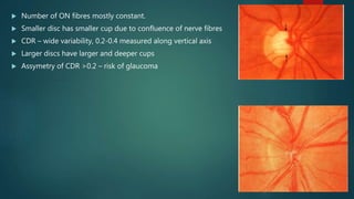 CONGENITAL OPTIC DISC ANOMALIES | PPTX