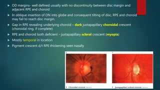 CONGENITAL OPTIC DISC ANOMALIES | PPTX