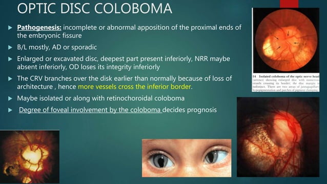 CONGENITAL OPTIC DISC ANOMALIES | PPTX | Eye and Vision Conditions ...