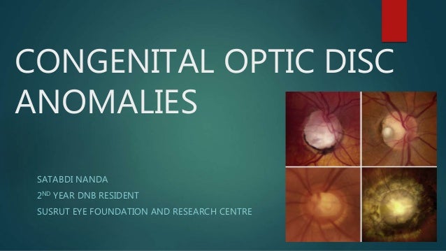 CONGENITAL OPTIC DISC ANOMALIES