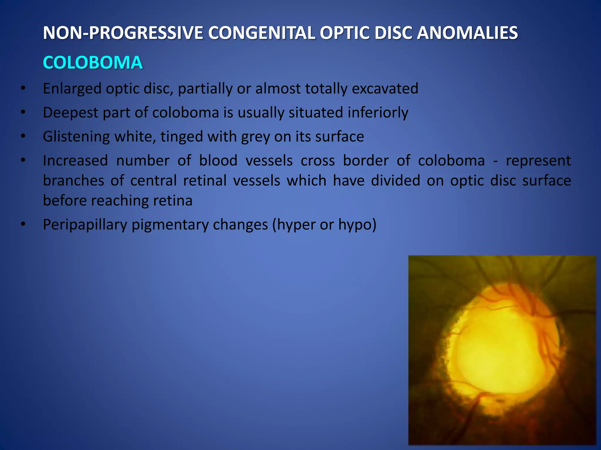 Optic disc evaluation | PPTX
