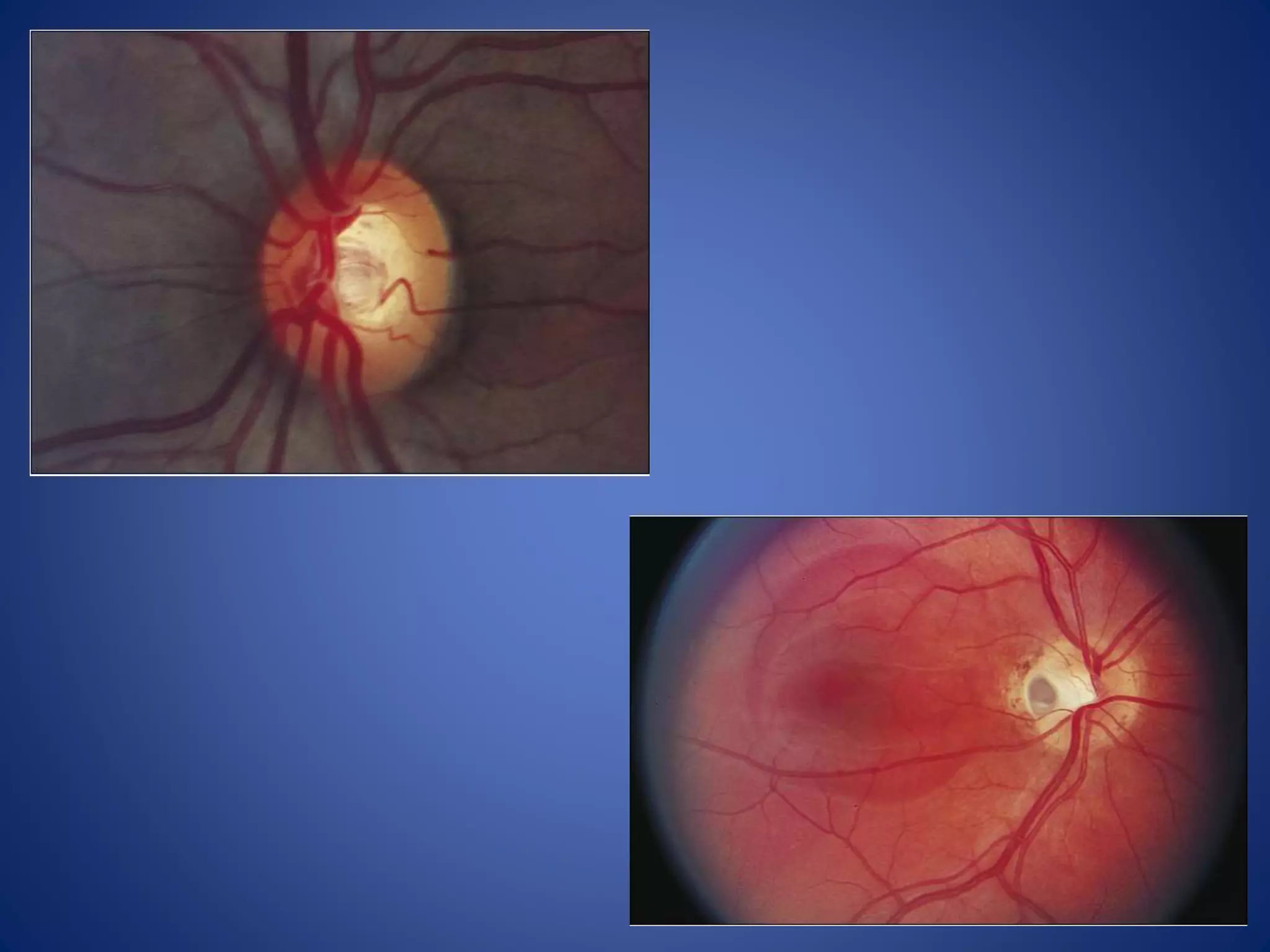 Optic disc evaluation | PPTX