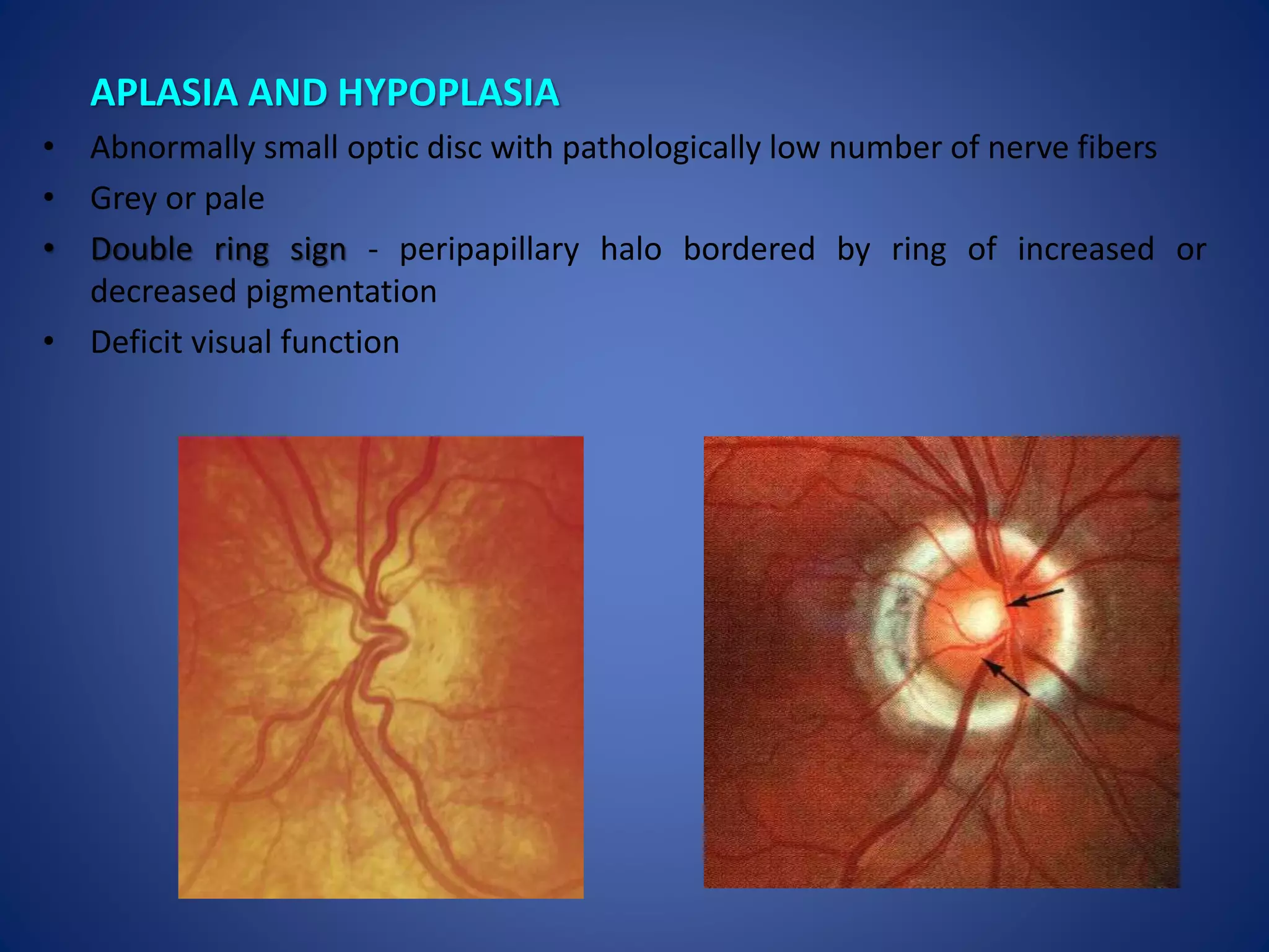 Optic disc evaluation | PPTX