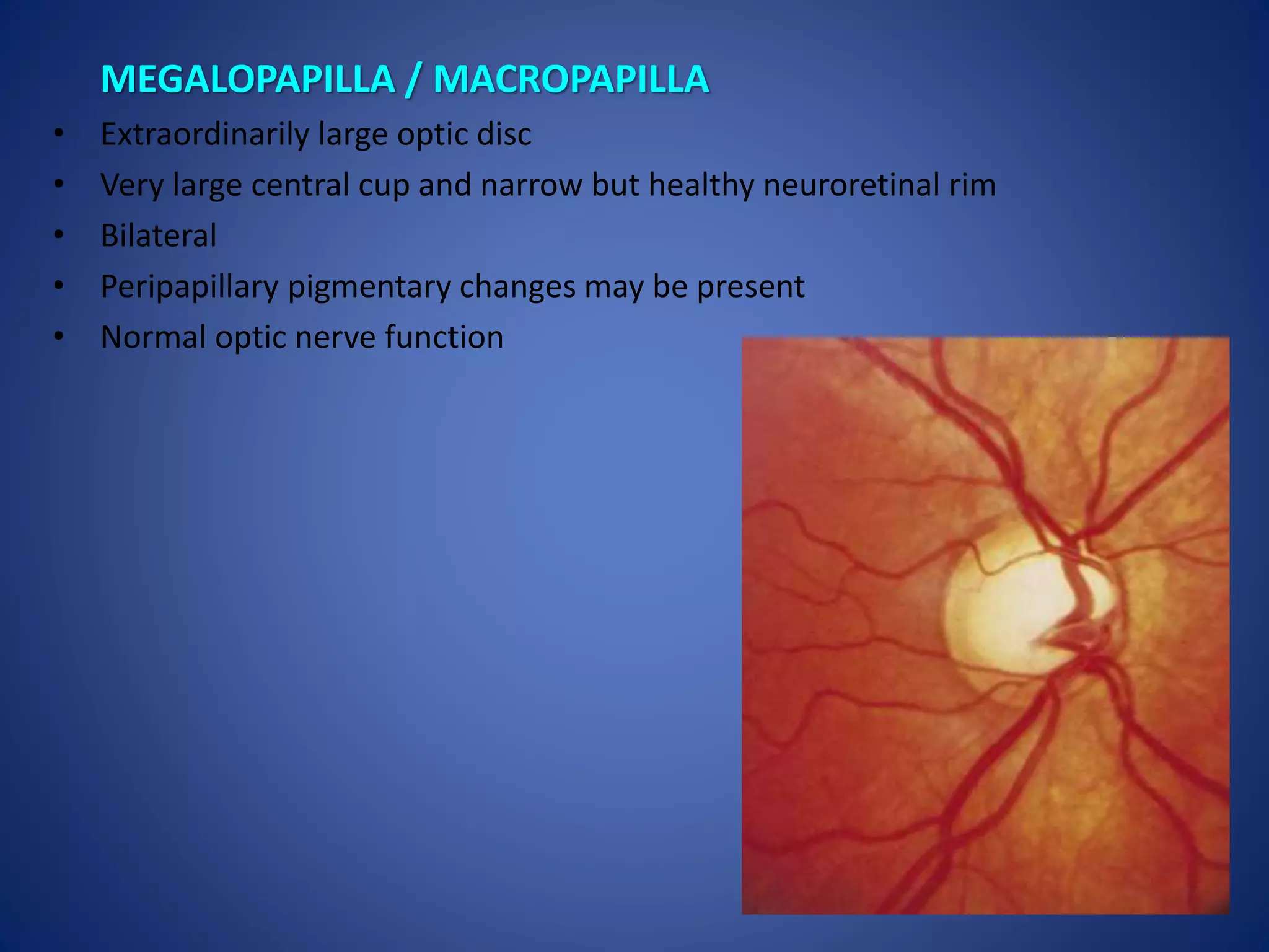 Optic disc evaluation | PPTX