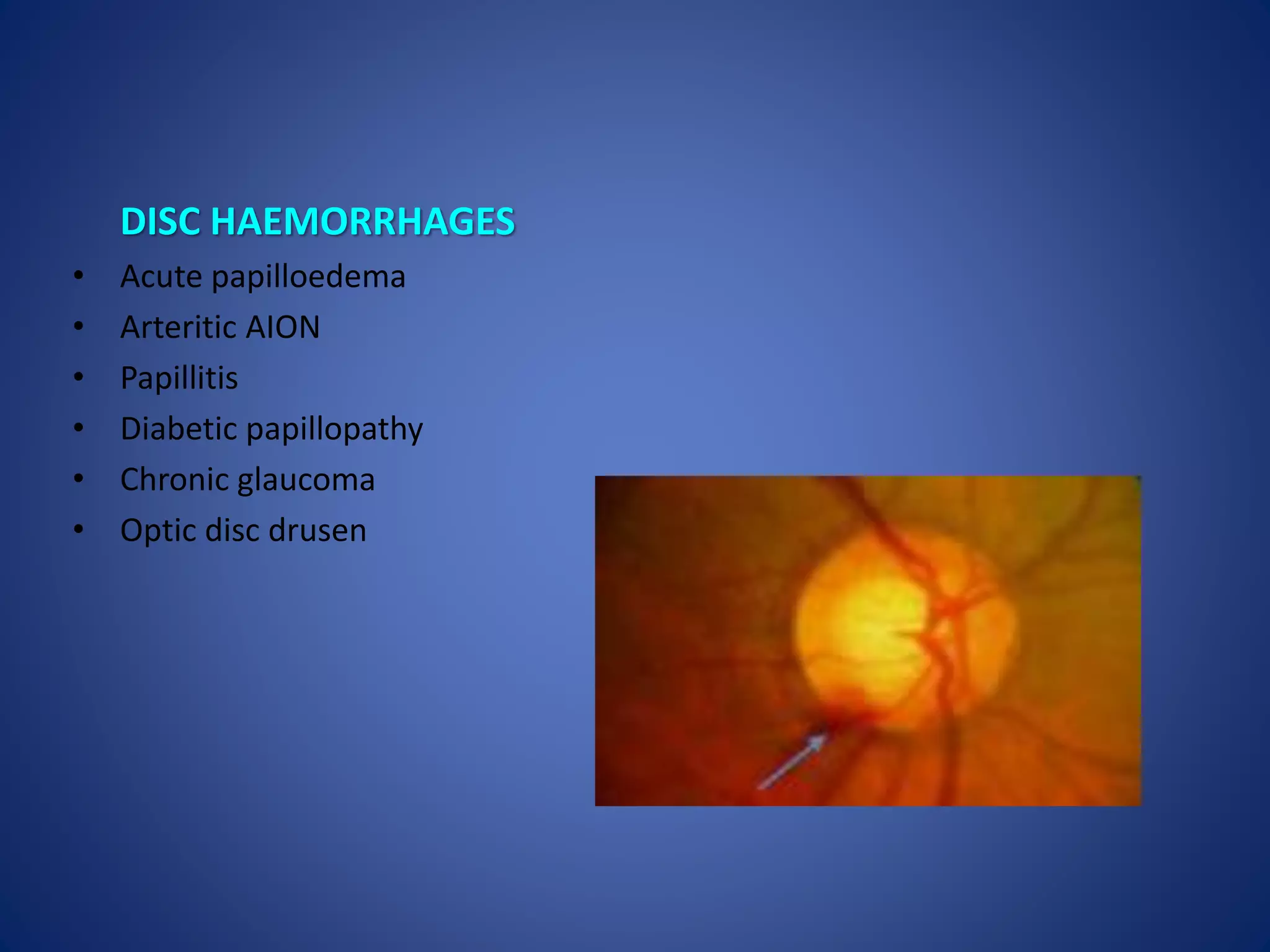 Optic disc evaluation | PPTX
