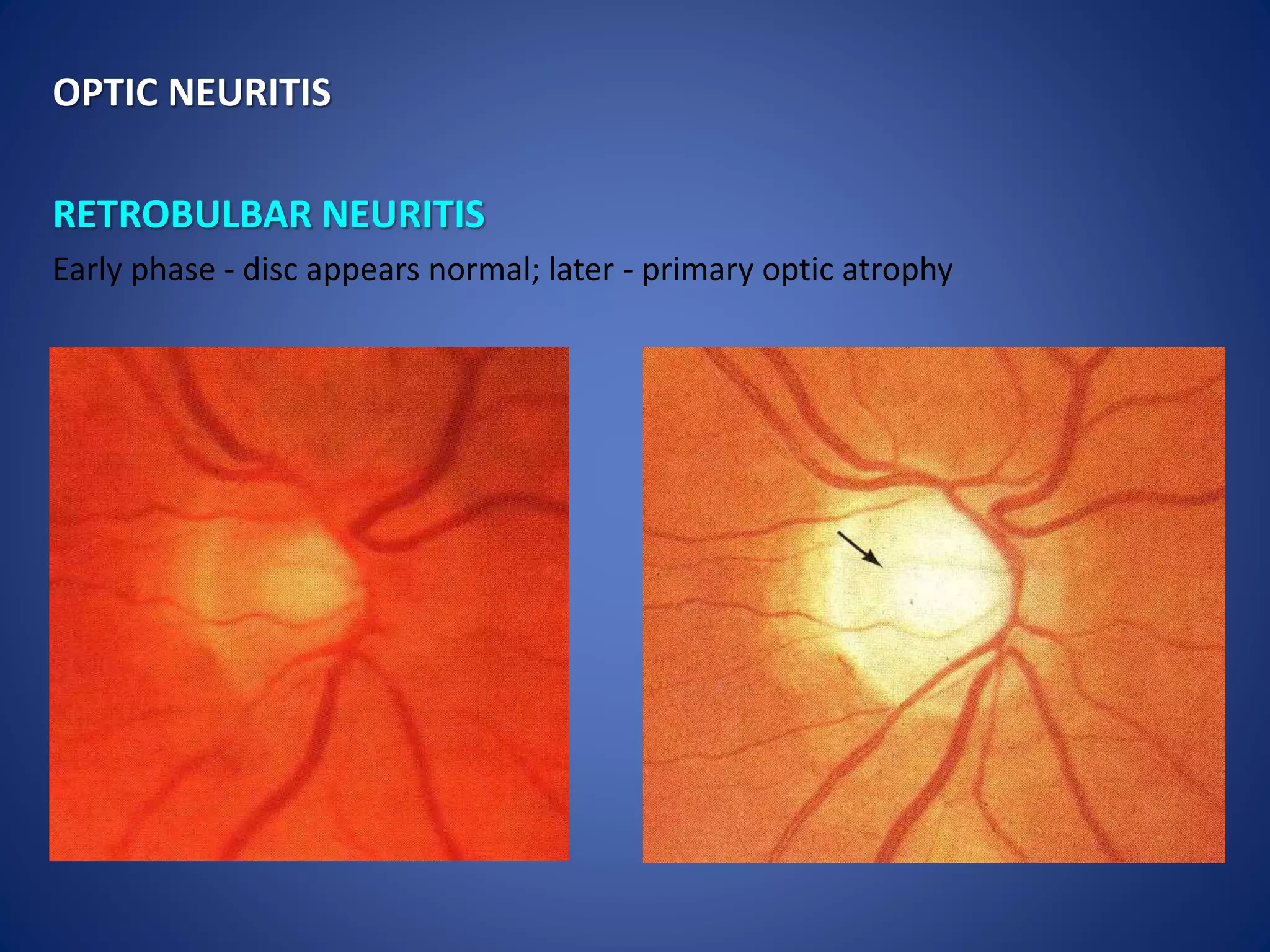 Optic disc evaluation | PPTX