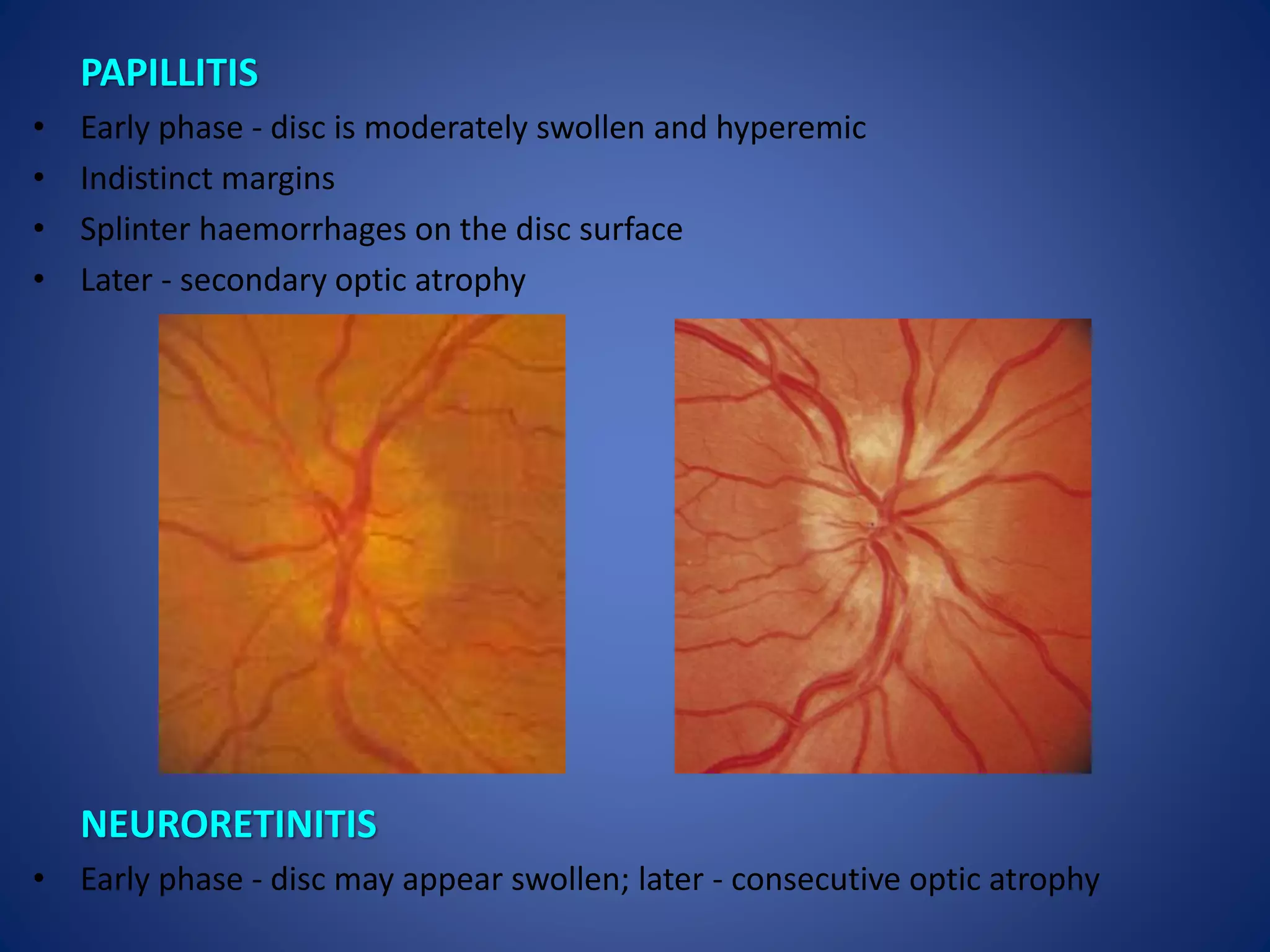 Optic disc evaluation | PPTX