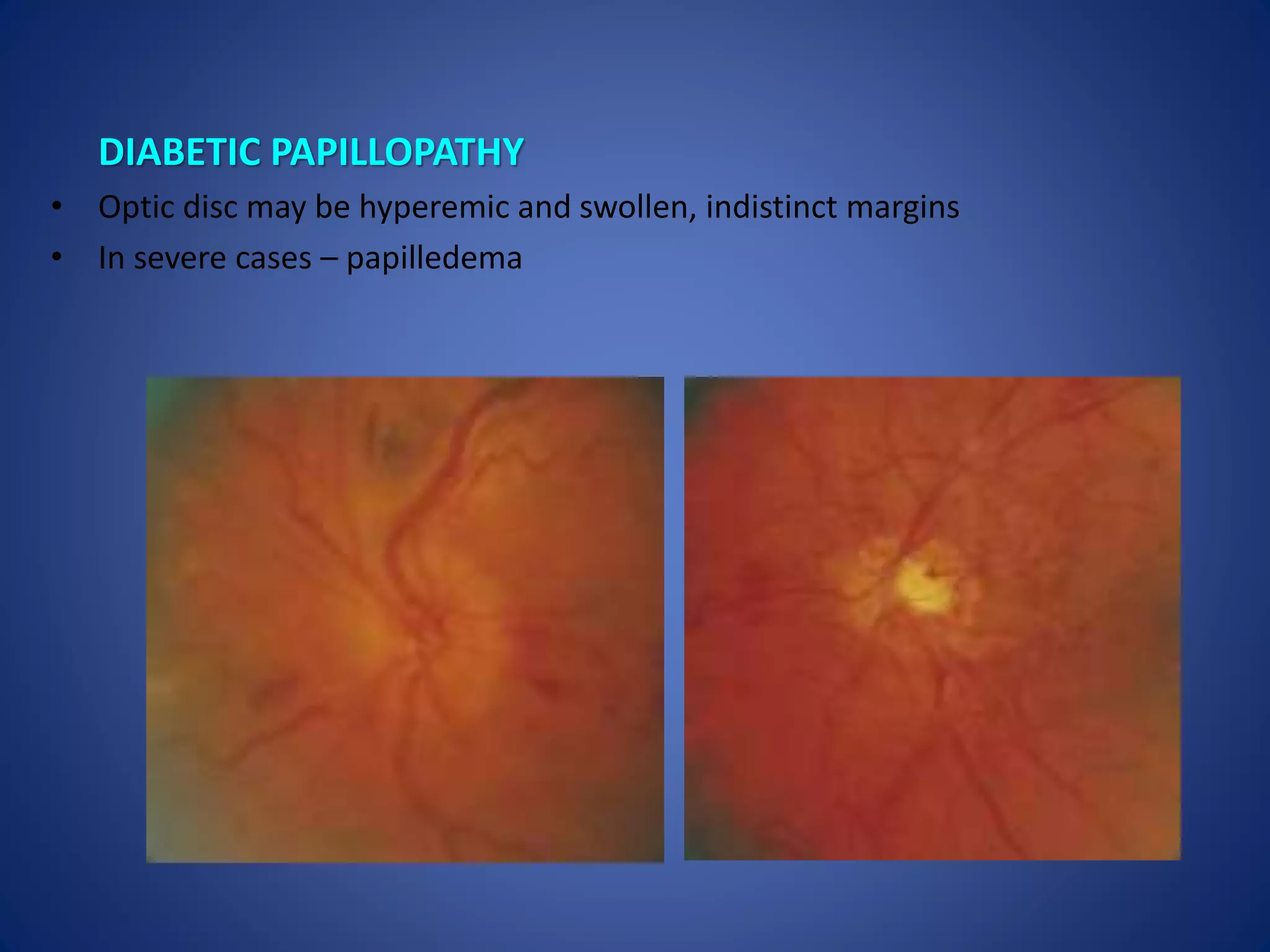 Optic disc evaluation | PPTX