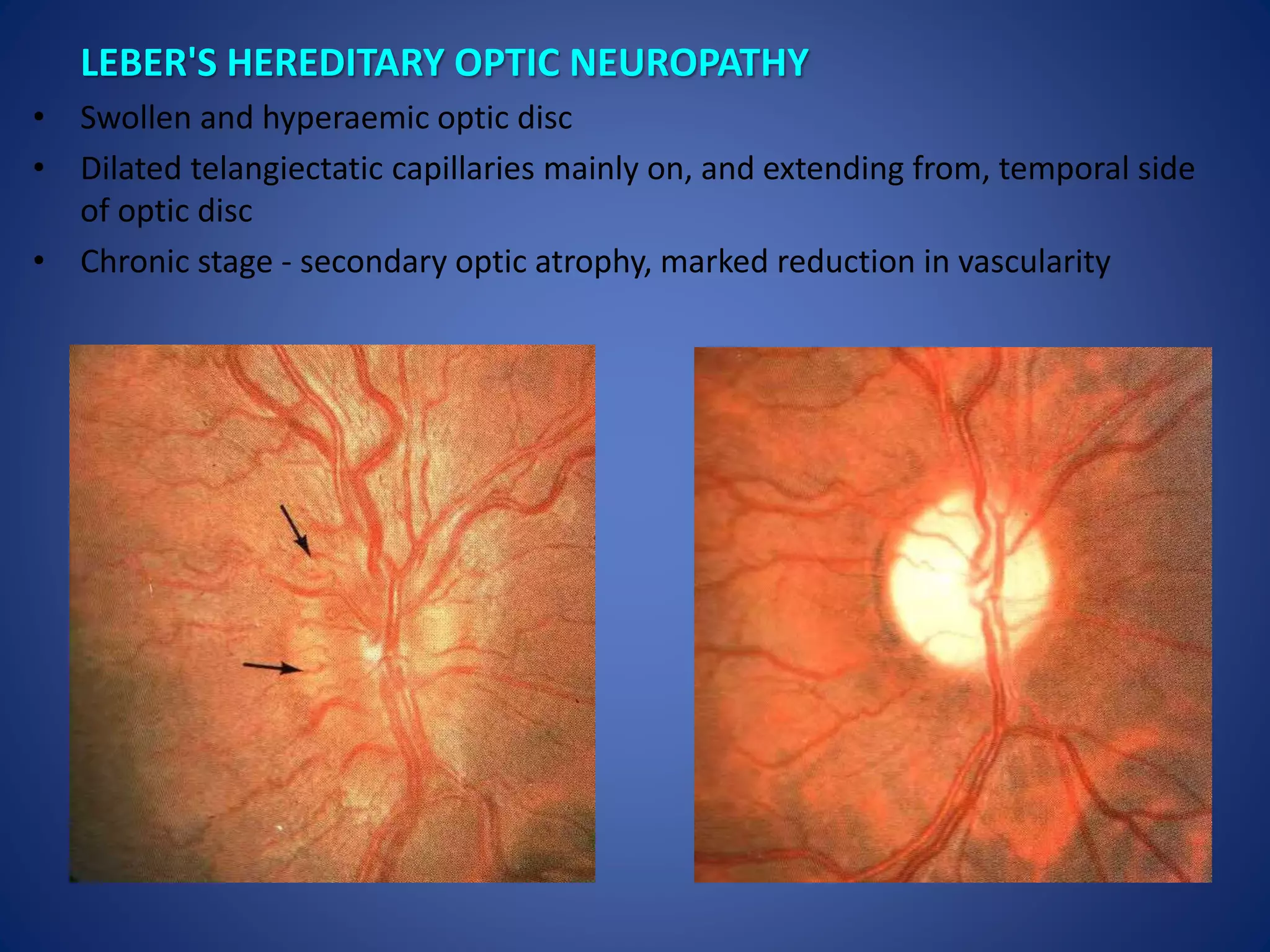 Optic disc evaluation | PPTX