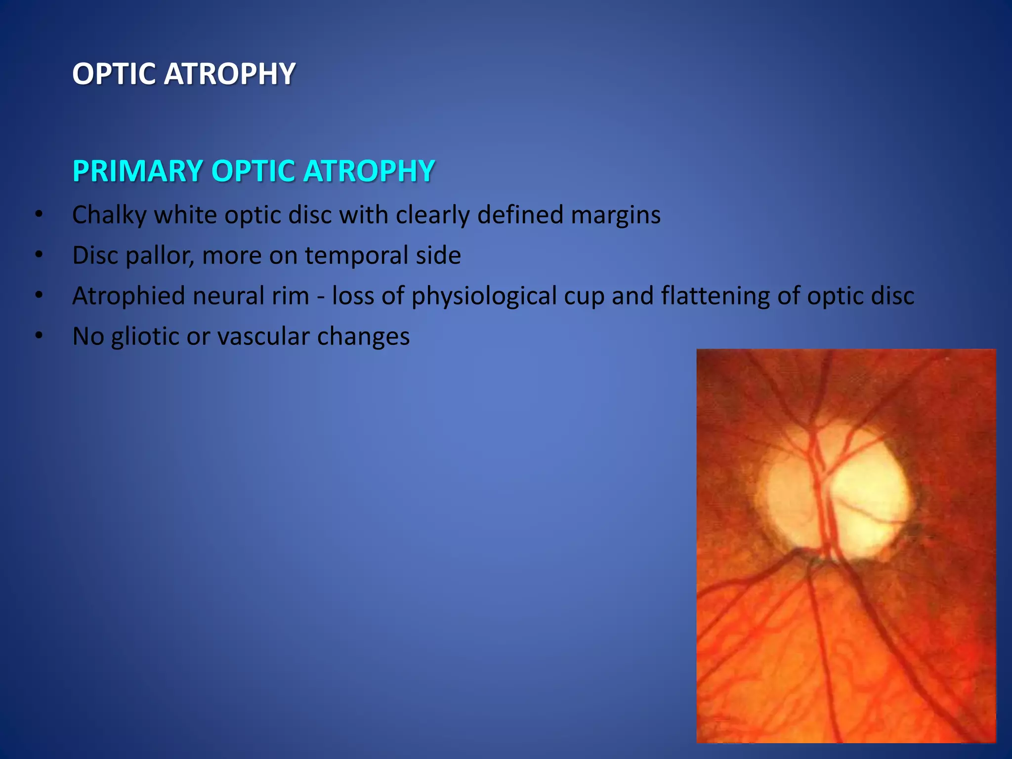 Optic disc evaluation | PPTX