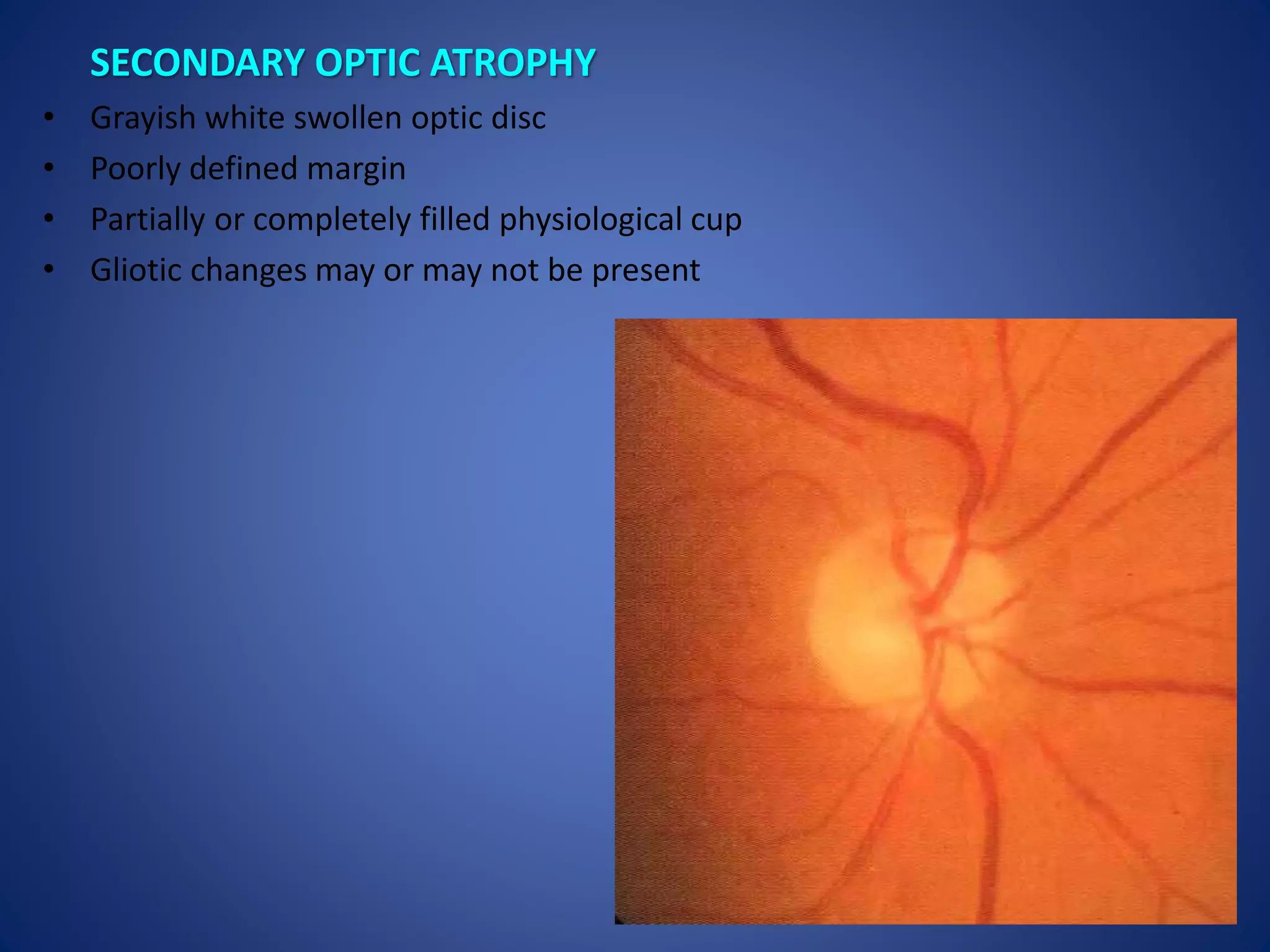 Optic disc evaluation | PPTX