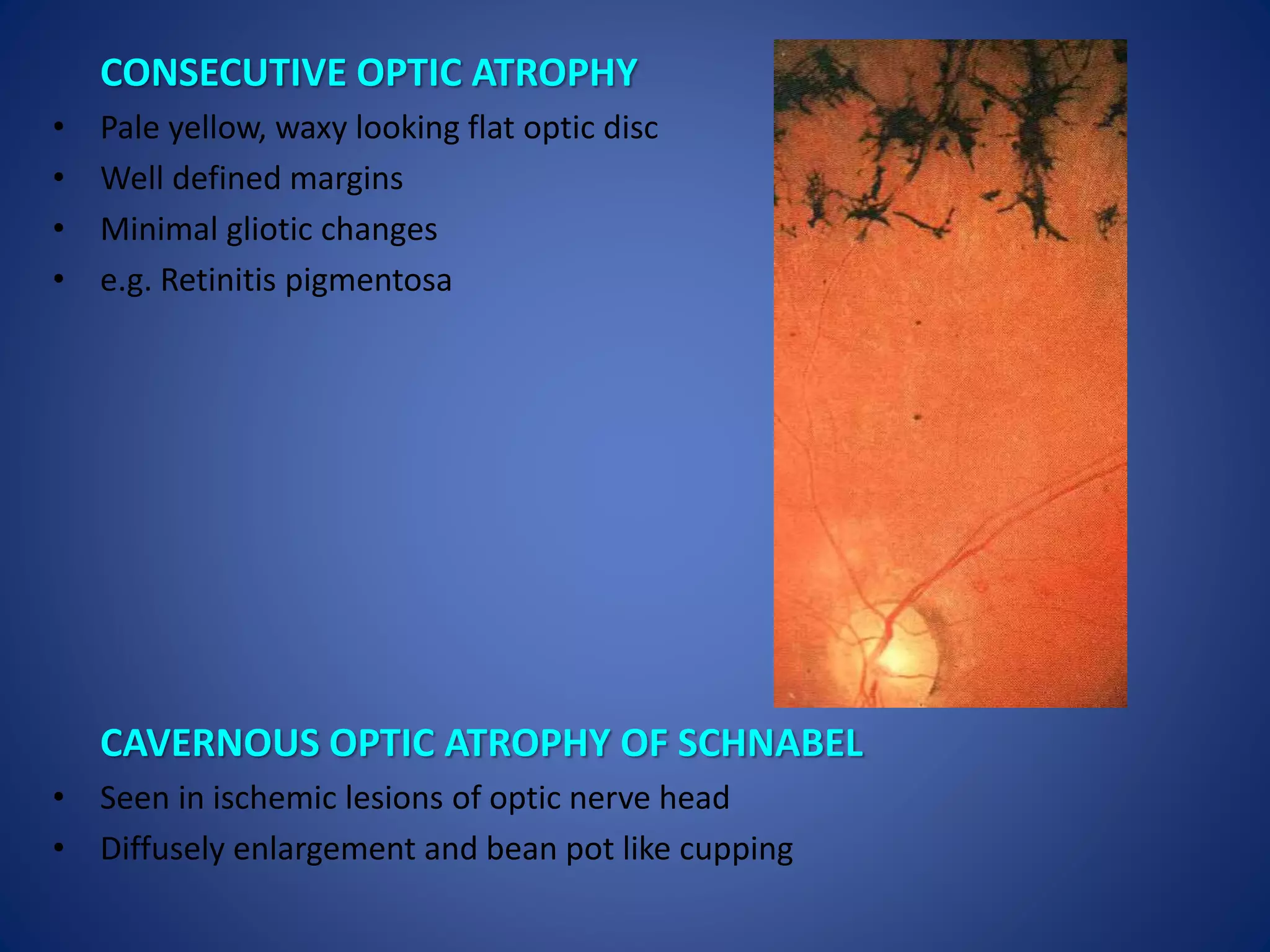 Optic disc evaluation | PPTX
