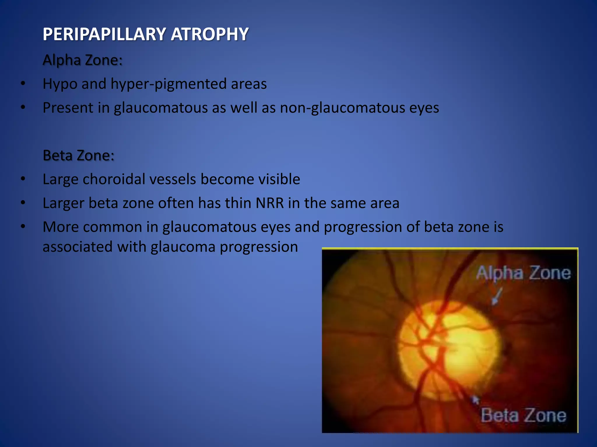 Optic disc evaluation | PPTX