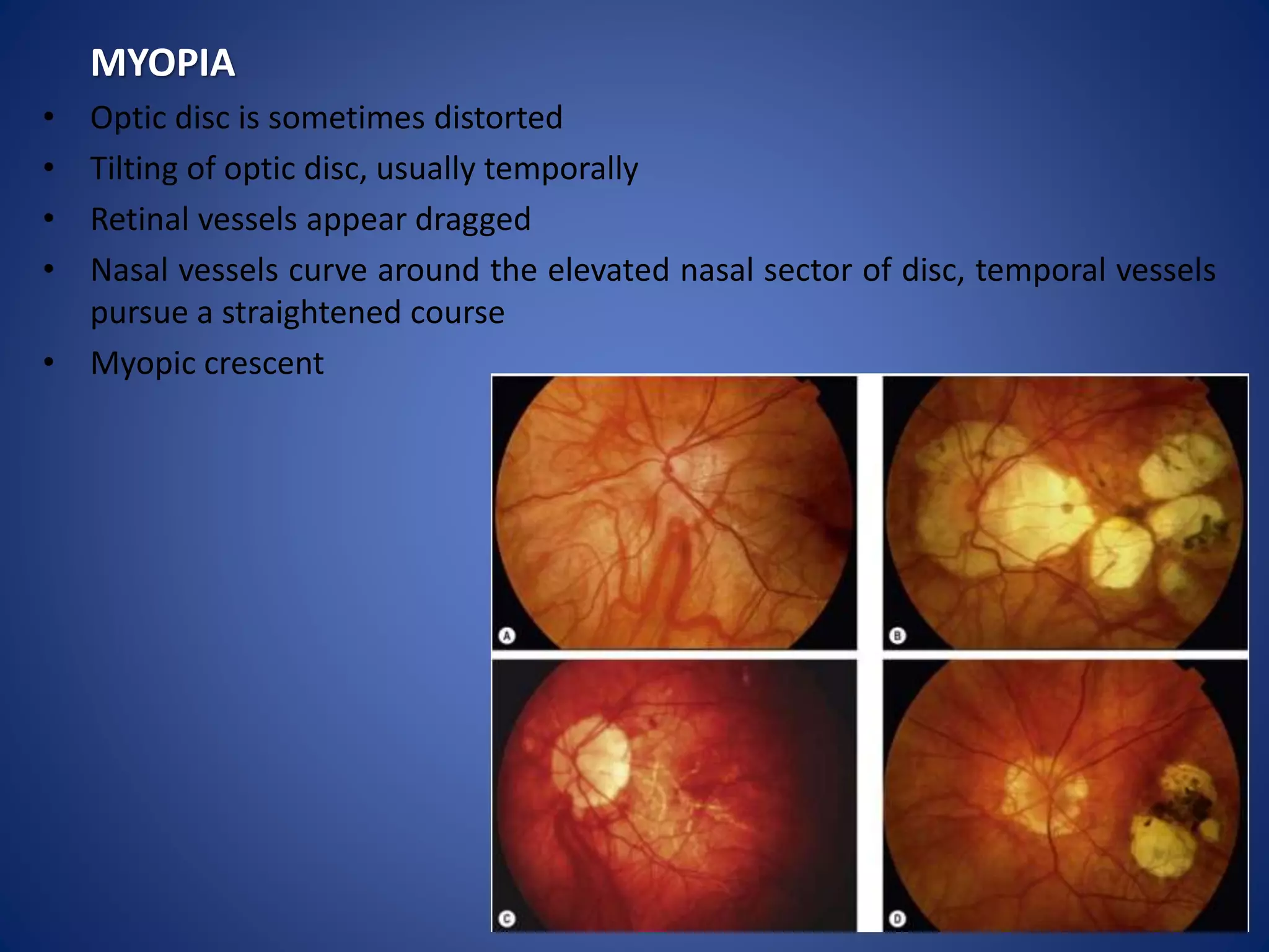 Optic disc evaluation | PPTX