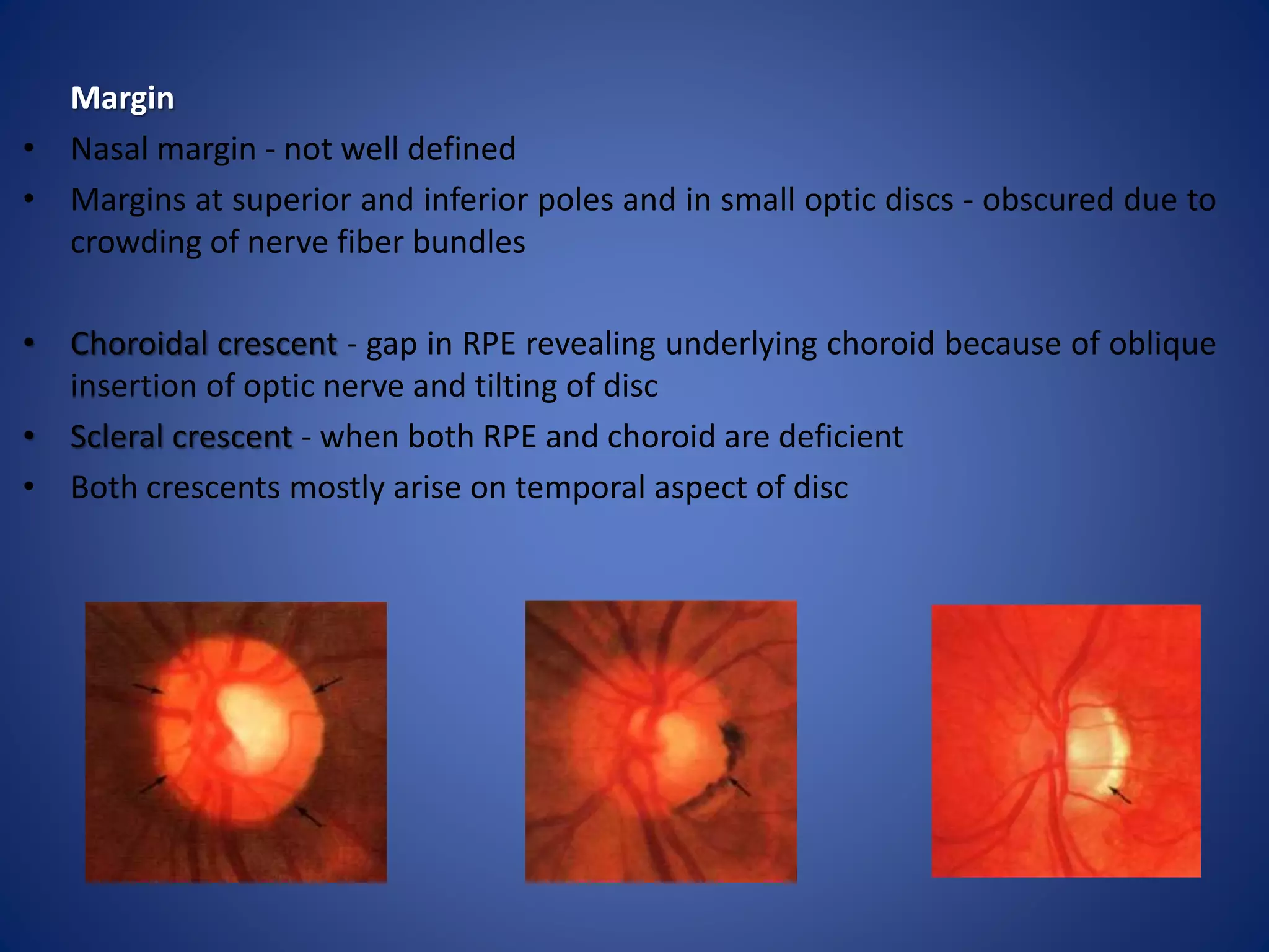 Optic disc evaluation | PPTX