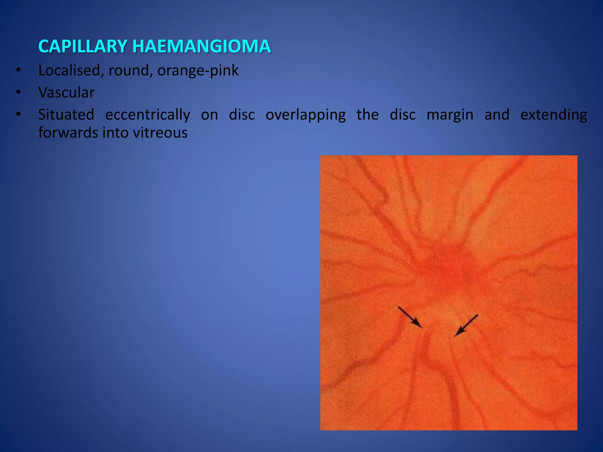 Optic disc evaluation | PPTX