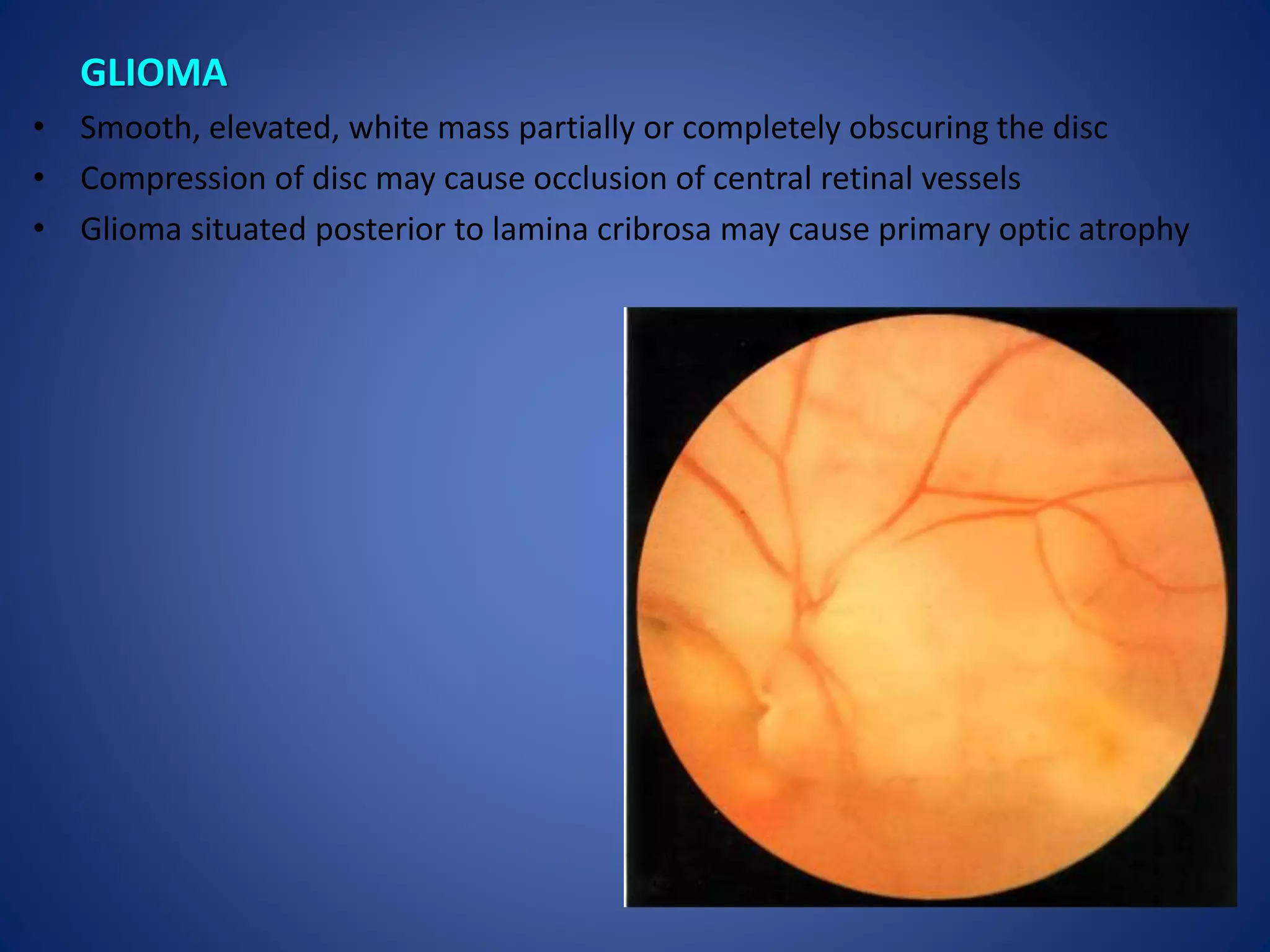 Optic disc evaluation | PPTX