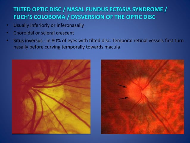 Optic disc evaluation | PPTX
