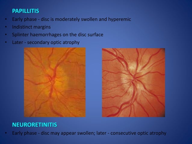 Optic disc evaluation | PPTX