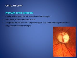 Optic disc evaluation | PPTX