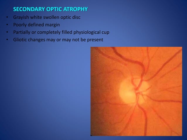 Optic disc evaluation | PPTX