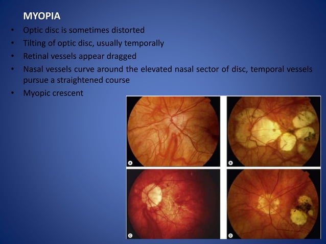 Optic disc evaluation | PPTX