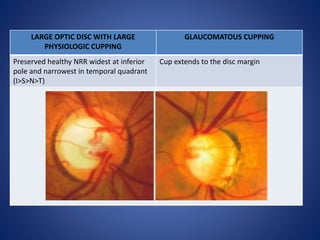 Optic disc evaluation | PPTX