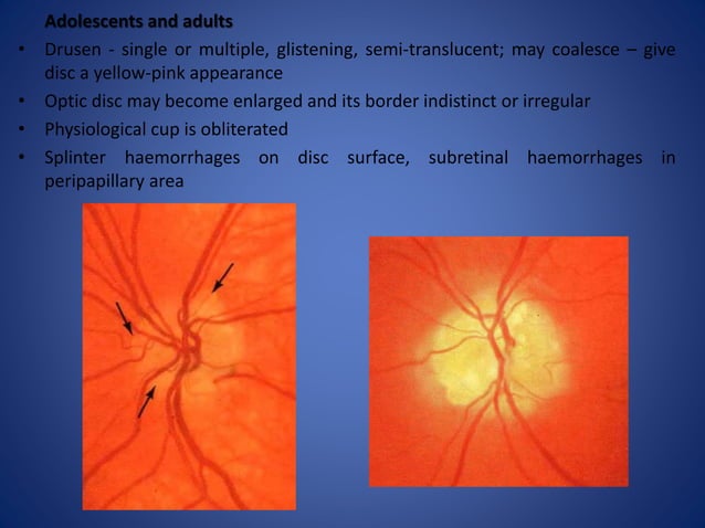 Optic disc evaluation | PPTX