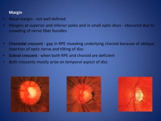 Optic disc evaluation | PPTX