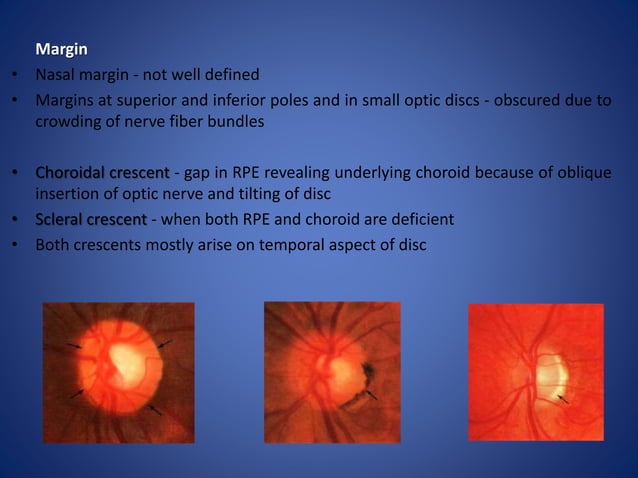 Optic disc evaluation | PPTX