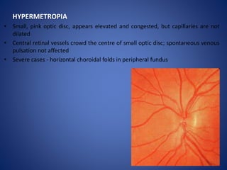 Choroidal Crescent Optic Disc